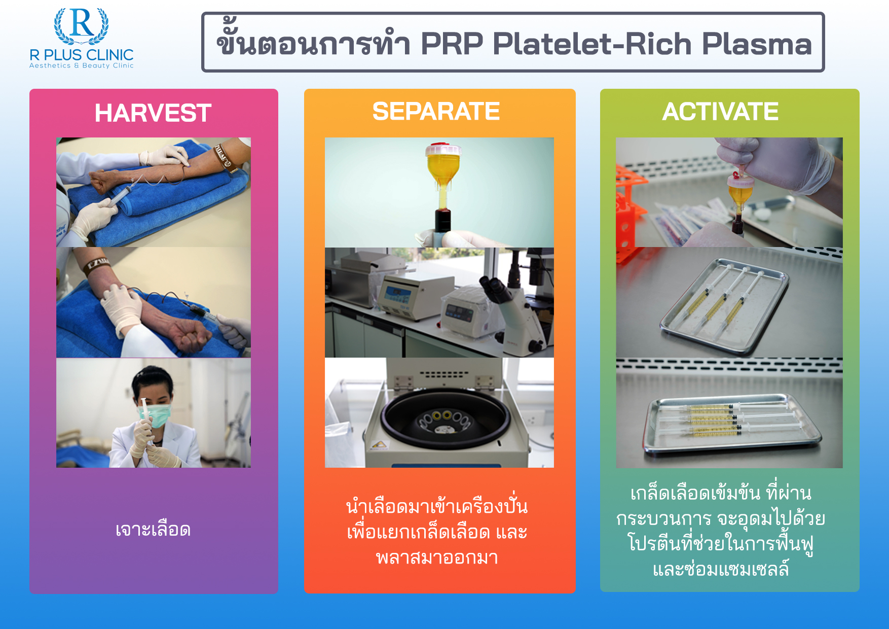 PRP (PLATELET-RICH PLASMA) คืออะไร ? – R Plus Clinic
